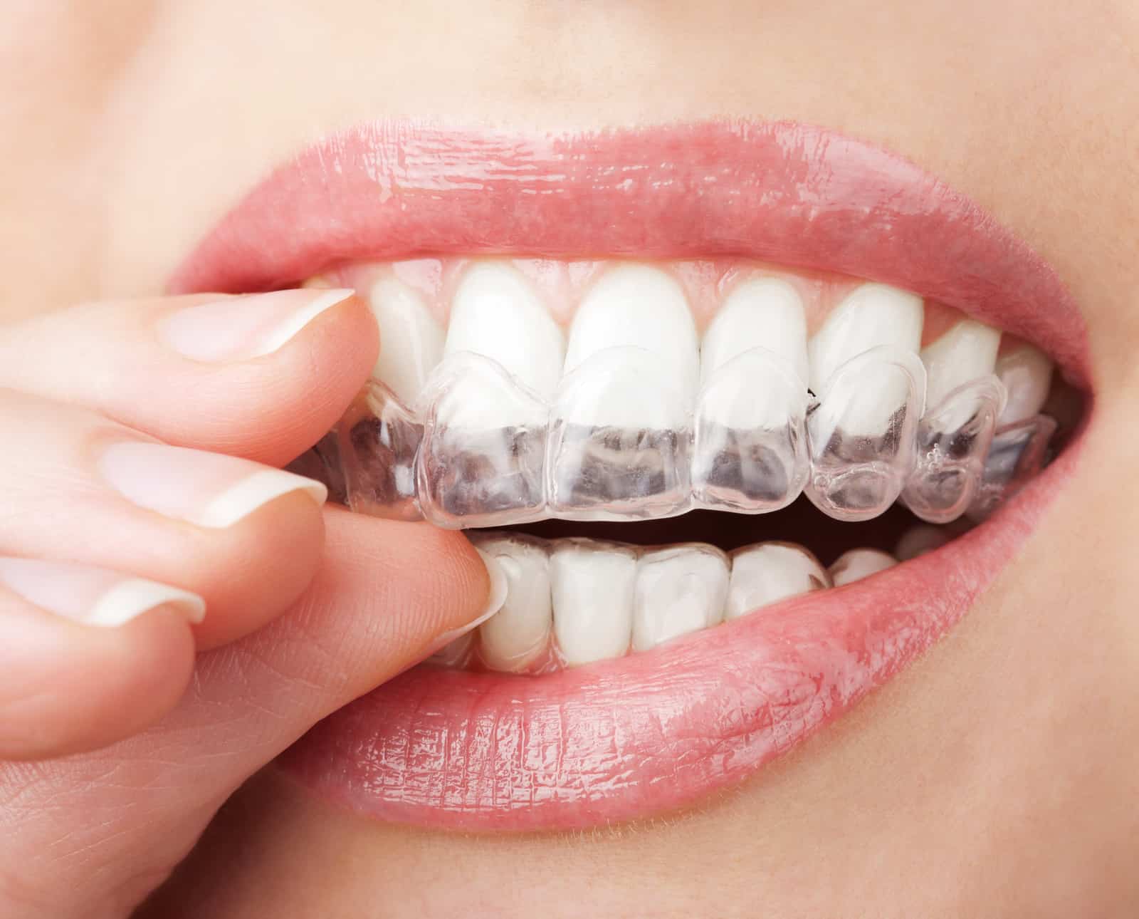 Post-Invisalign Care: Maintaining Your Perfect Smile - Acacia Dental